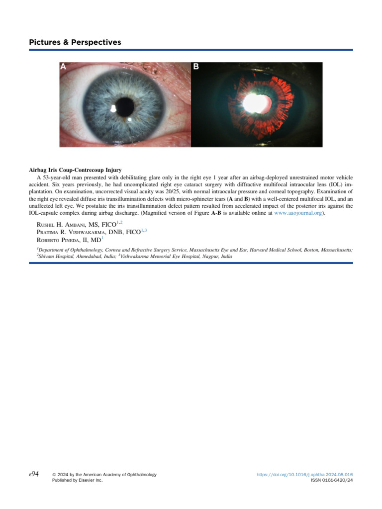 Airbag Iris Coup Contrecoup Injury 2024 Ophtha | PDF