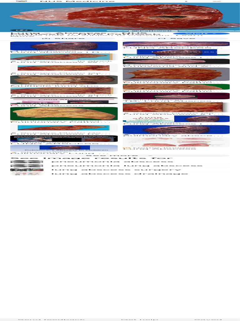 Abscess Pneumonia Gross | PDF