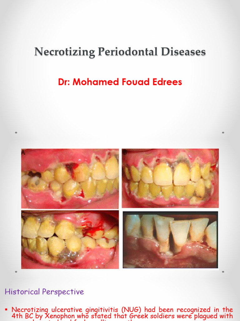 Understanding Necrotizing Periodontal Diseases | PDF | Periodontology | Medical Specialties