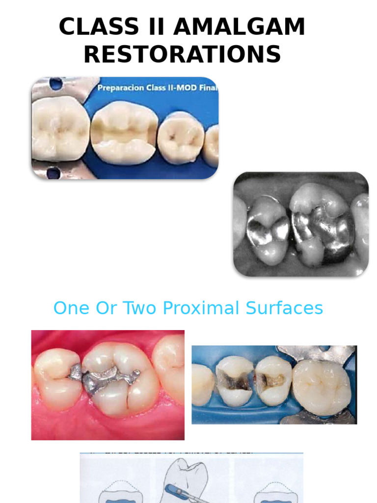 CL II Amalgam Restoration | PDF | Tooth Enamel | Dental Anatomy