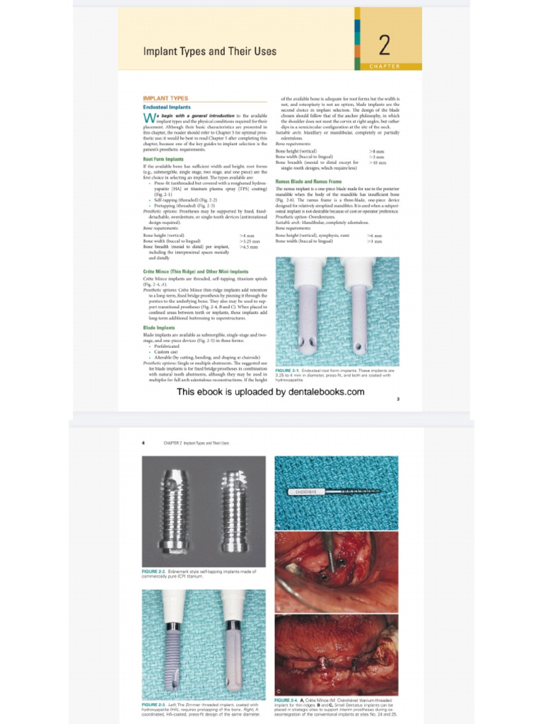 Chapter 2 Atlas. Implant Types and Their Uses | PDF