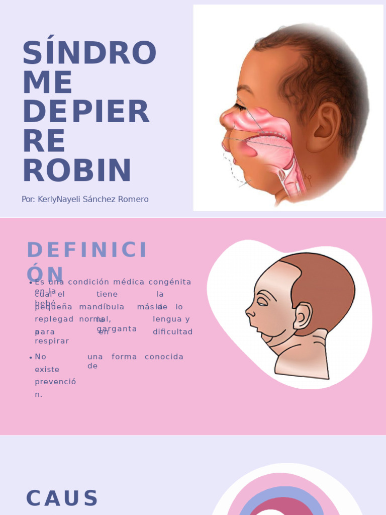 Pierre Robin | PDF | Medicina CLINICA | Enfermedades y trastornos humanos