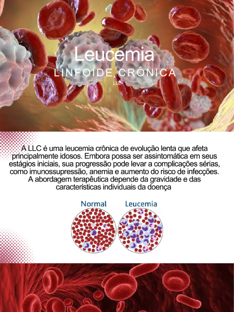 Leucemia PDF | PDF