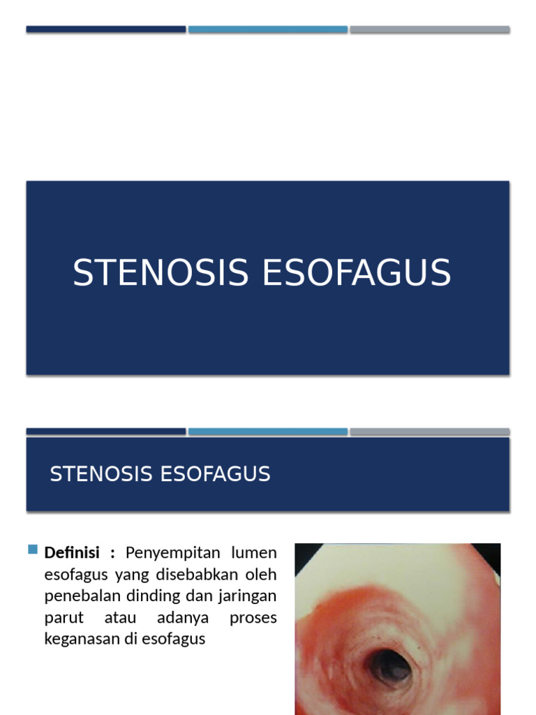 Stenosis Striktur Esofagus Stenosis Trakea | PDF