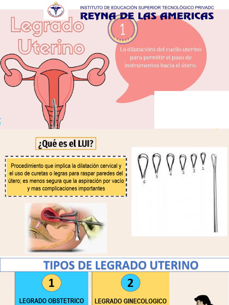 Semana16.2. Legrado Uterino | PDF