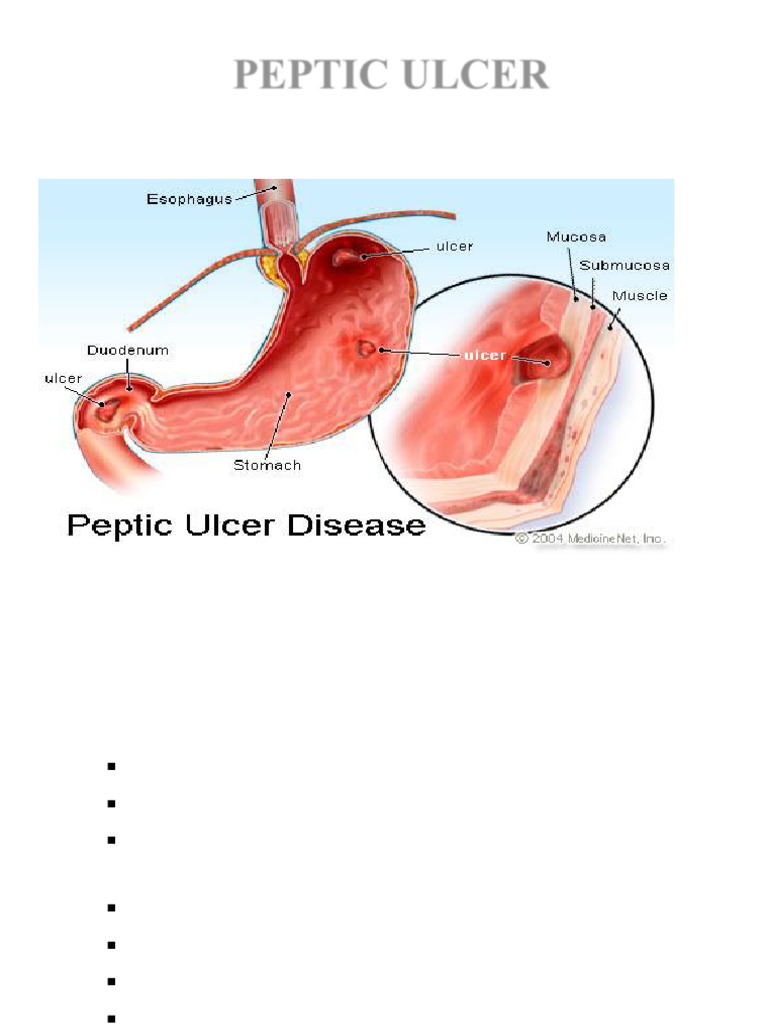 Surg 2 Perforated Peptic Ulcer Uds | PDF | Stomach | Gastroenterology