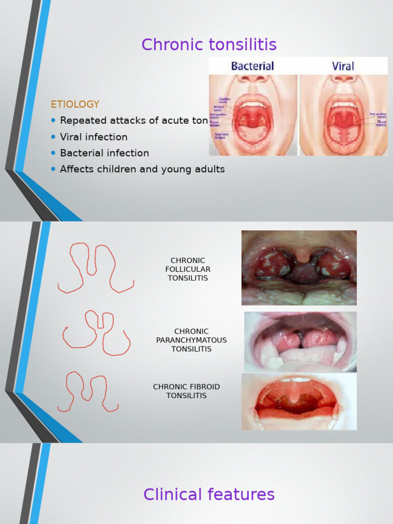 Chronic Tonsilitis | PDF