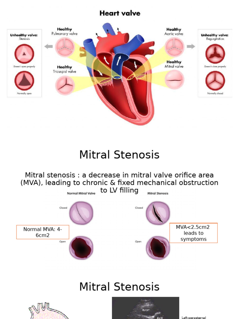 mitral stenosis | PDF