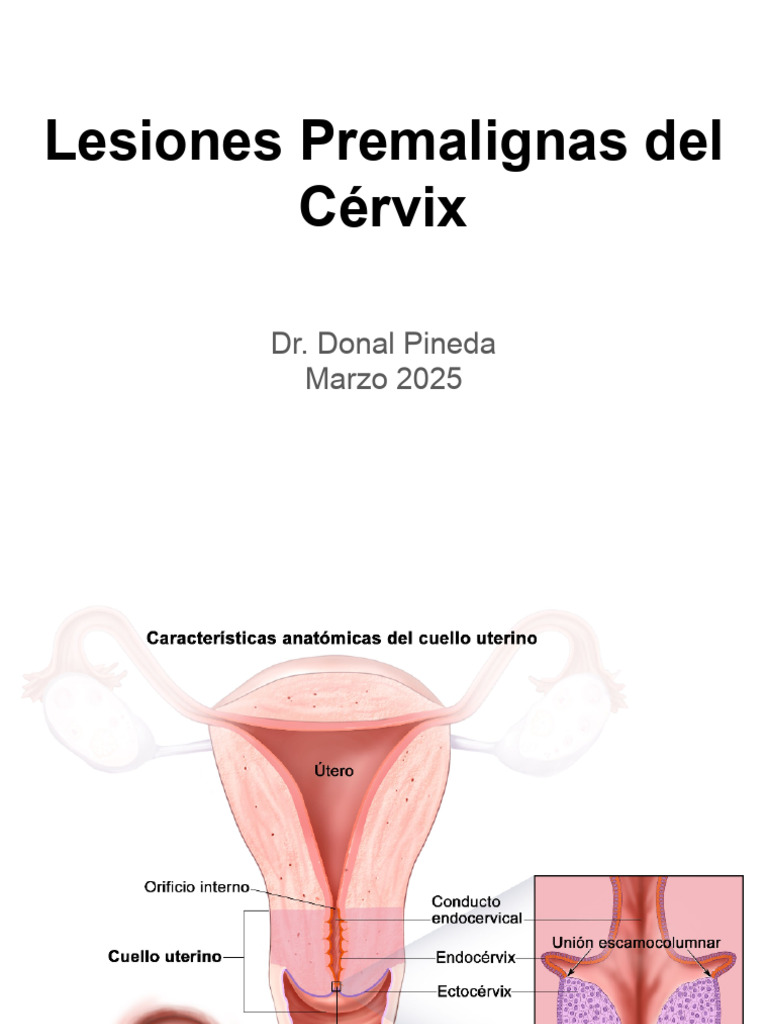 Lesiones Premalignas de Cervix - Ca de Cervix dp0325 | PDF