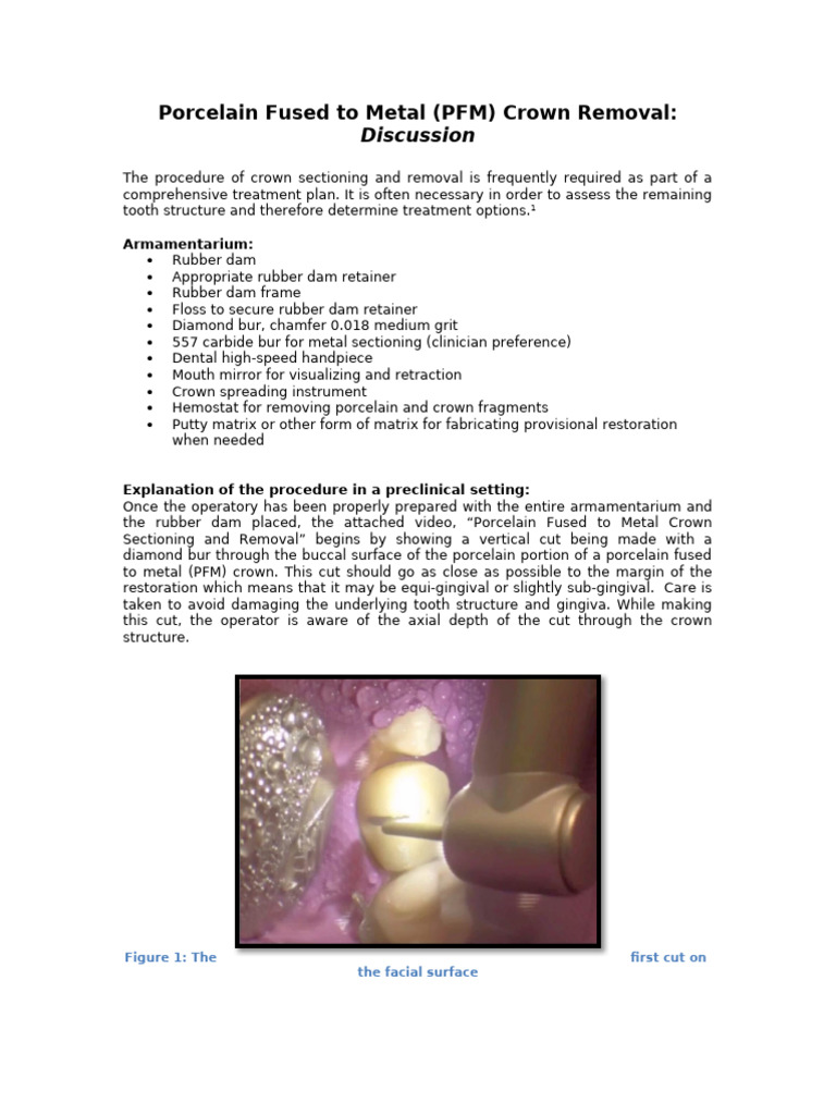 PFM Crown Removal Procedure Guide | PDF | Dentistry Branches | Dentistry