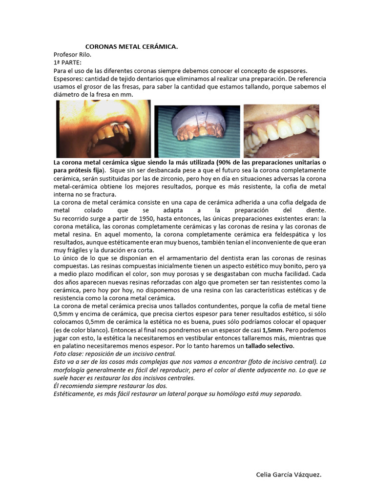 Ventajas y desventajas de coronas metal-cerámicas | PDF | Ramas de ...