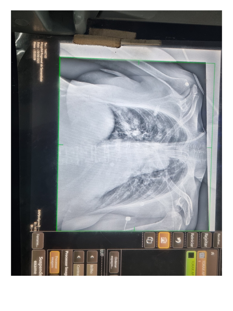 Analise RX Pulmonar | PDF