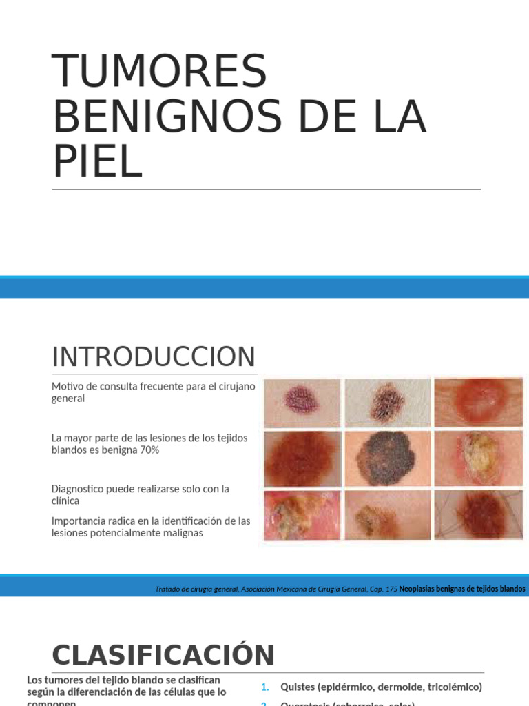 Tumores Benignos de Piel | PDF | Neoplasias | Tumor benigno