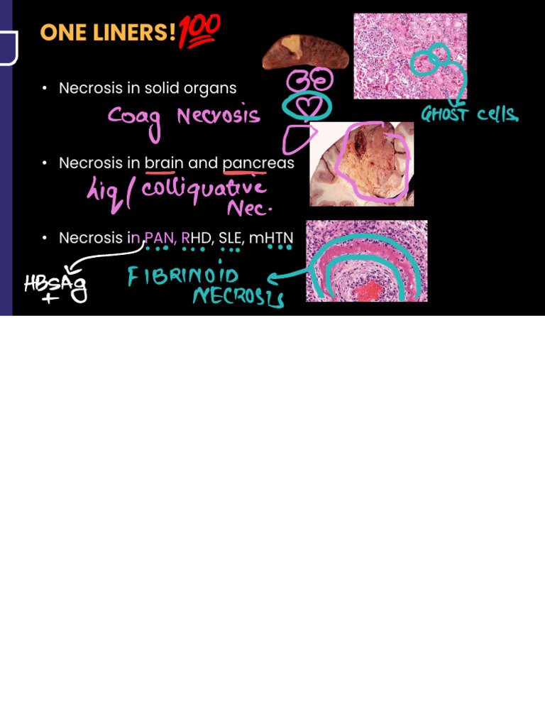 100 Essential Oneliners Pathology | PDF | Neoplasms | Leukemia