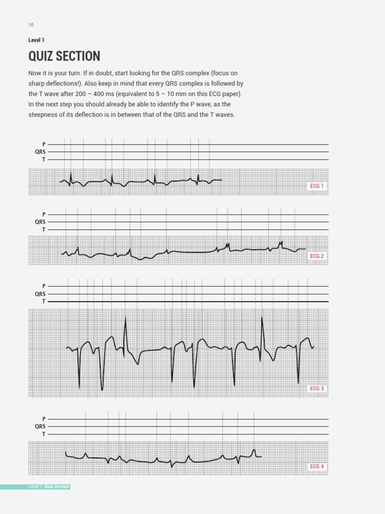 at The Blink of An Eye-Deconstructing The ECG Curve - Quiz | PDF