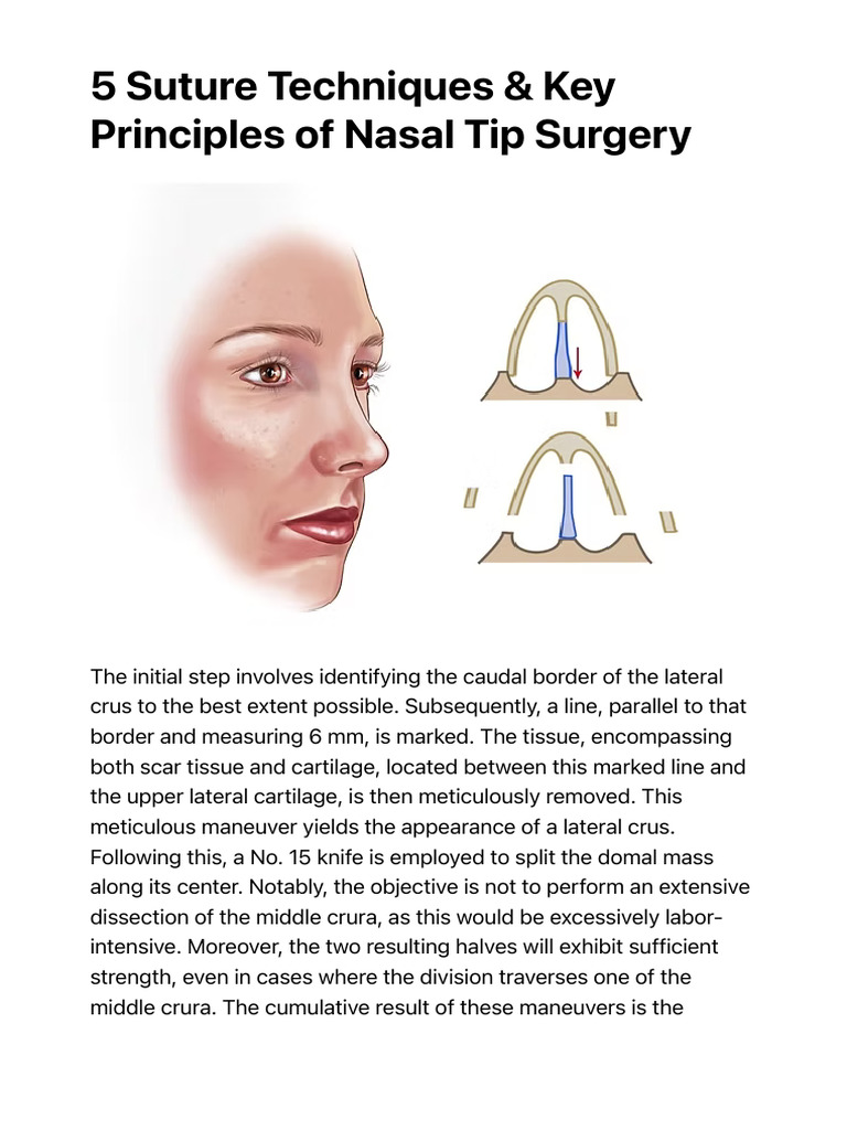 5 Suture Techniques & Key Principles of Nasal Tip Surgery | PDF