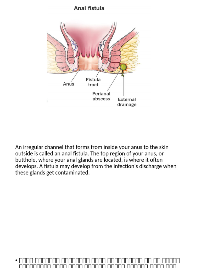 Perianal Fistula | PDF