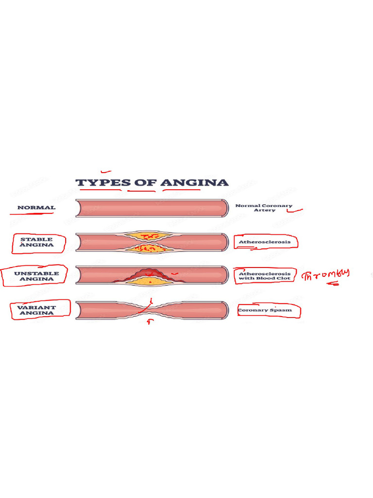 Angina | PDF