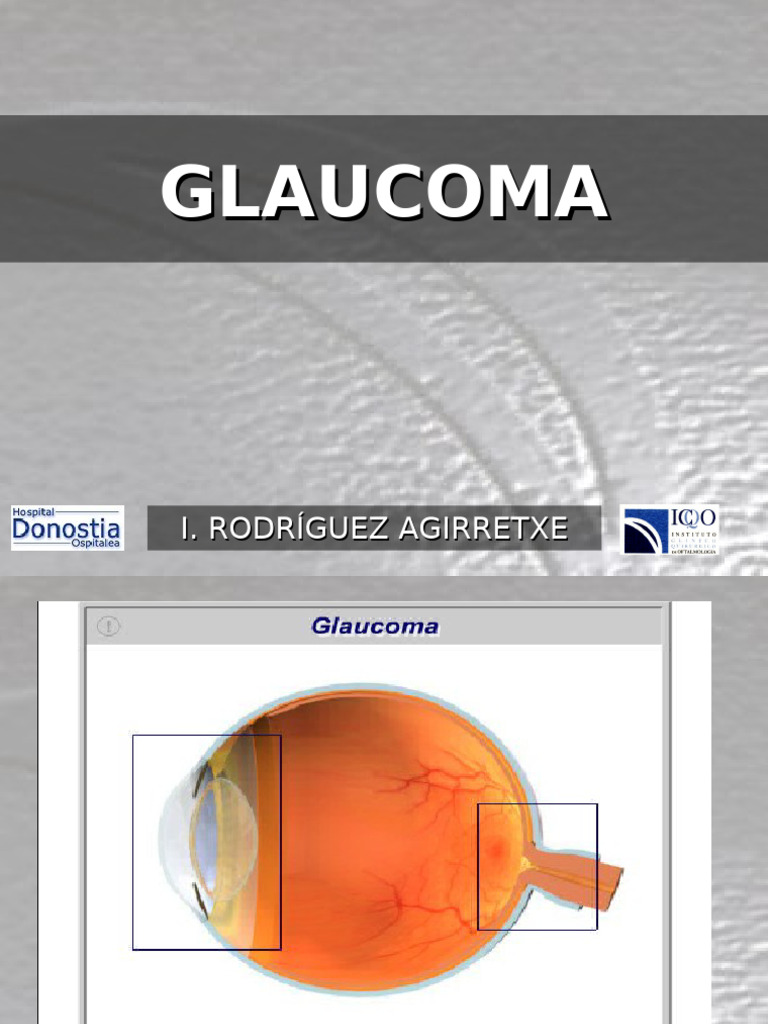 GLAUCOMA | PDF | Glaucoma | Oftalmología
