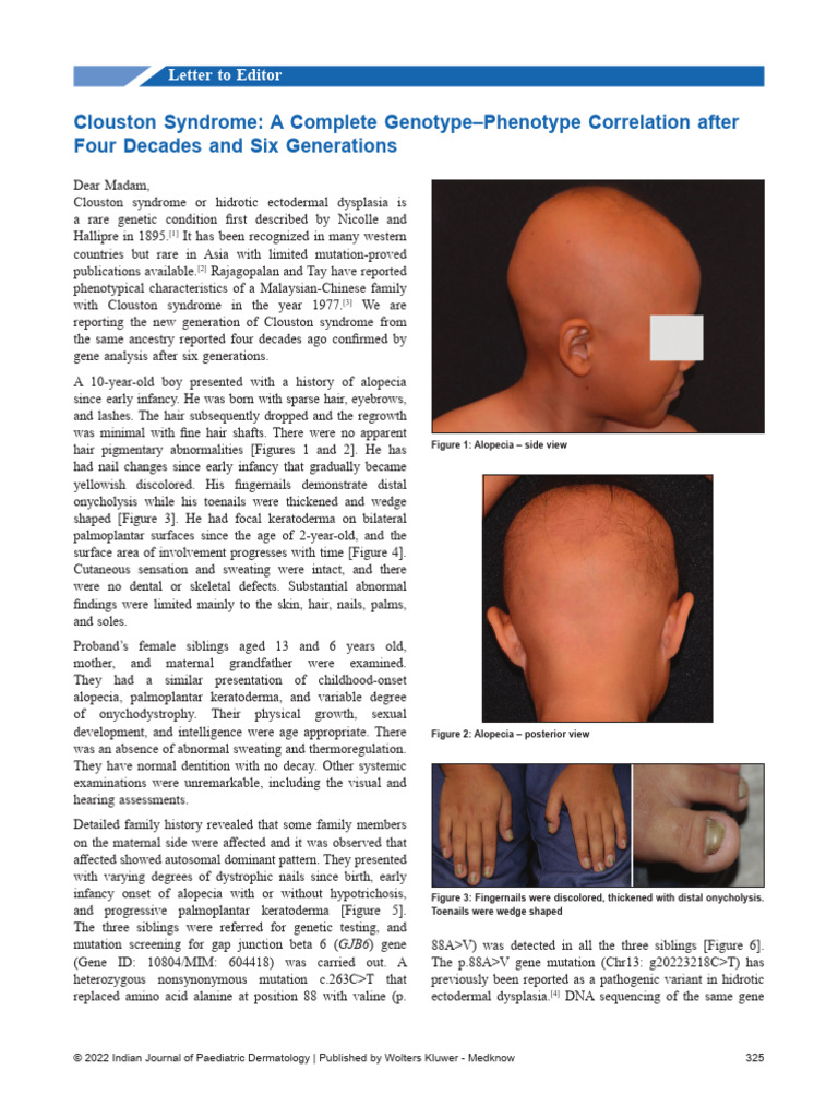 Clouston Syndrome A Complete Genotype Phenotype.15 | PDF | Nail ...