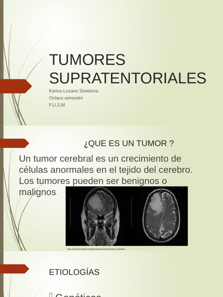 3.tumores Supratentoriales | PDF | Neoplasias | Glioma