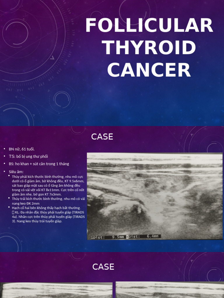 Follicular Thyroid Cancer | PDF