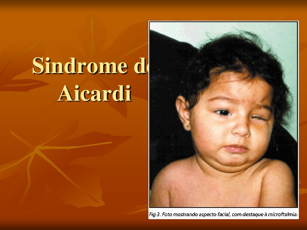 Sindrome de Aicardi | PDF