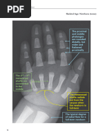 Greulich and Pyle Skeletal Age Atlas | PDF | Thumb | Limbs (Anatomy)