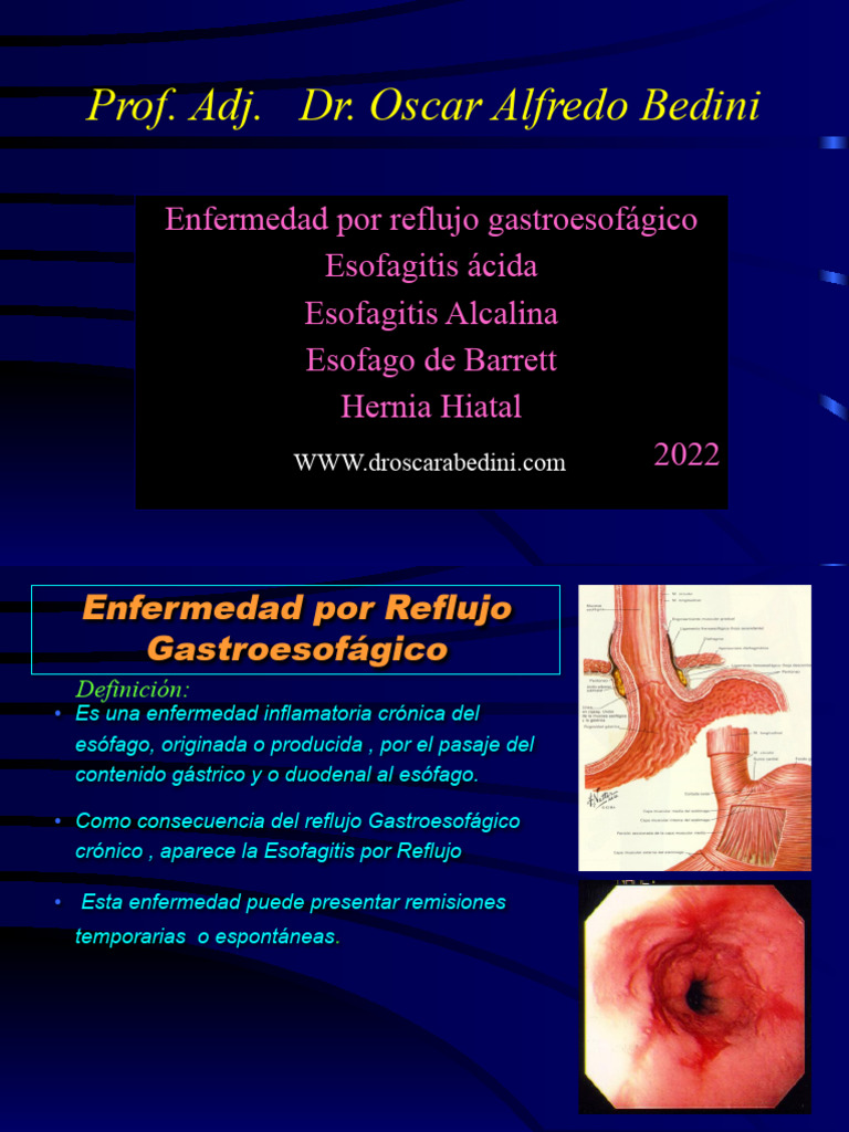 Enfermedad Por Reflujo Gastroesofagico - Esofago de Barret | PDF | La ...