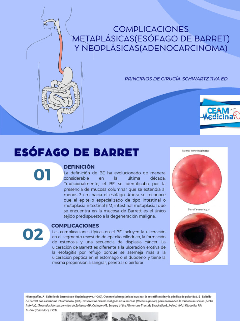 Complicaciones del Esófago de Barrett | PDF | La enfermedad por reflujo ...