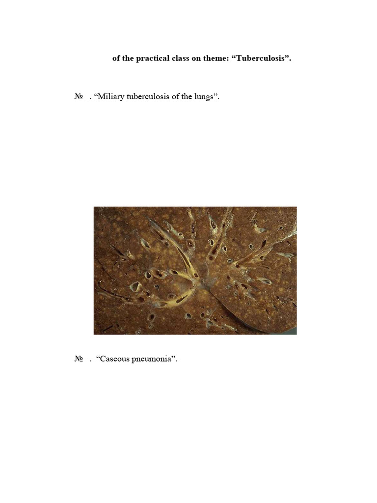 Practical class № 13. Tuberculosis. | PDF