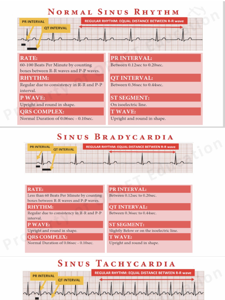 EKG Interpretation | PDF