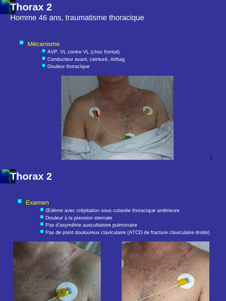 Thorax 2 | PDF
