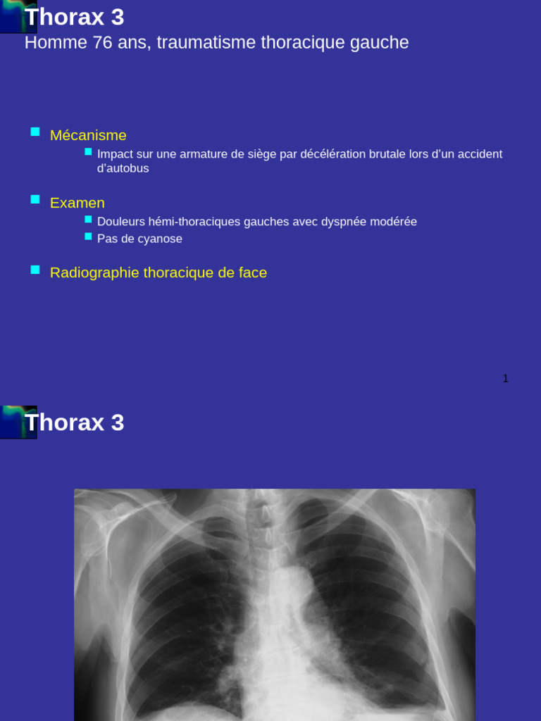 Fractures costales et volet costal | PDF