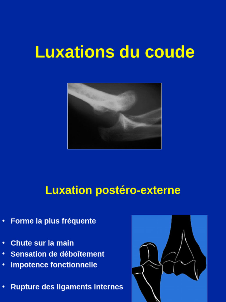 Illustration,cliché radio des luxations du coude | PDF | Membres (anatomie) | Appareil locomoteur