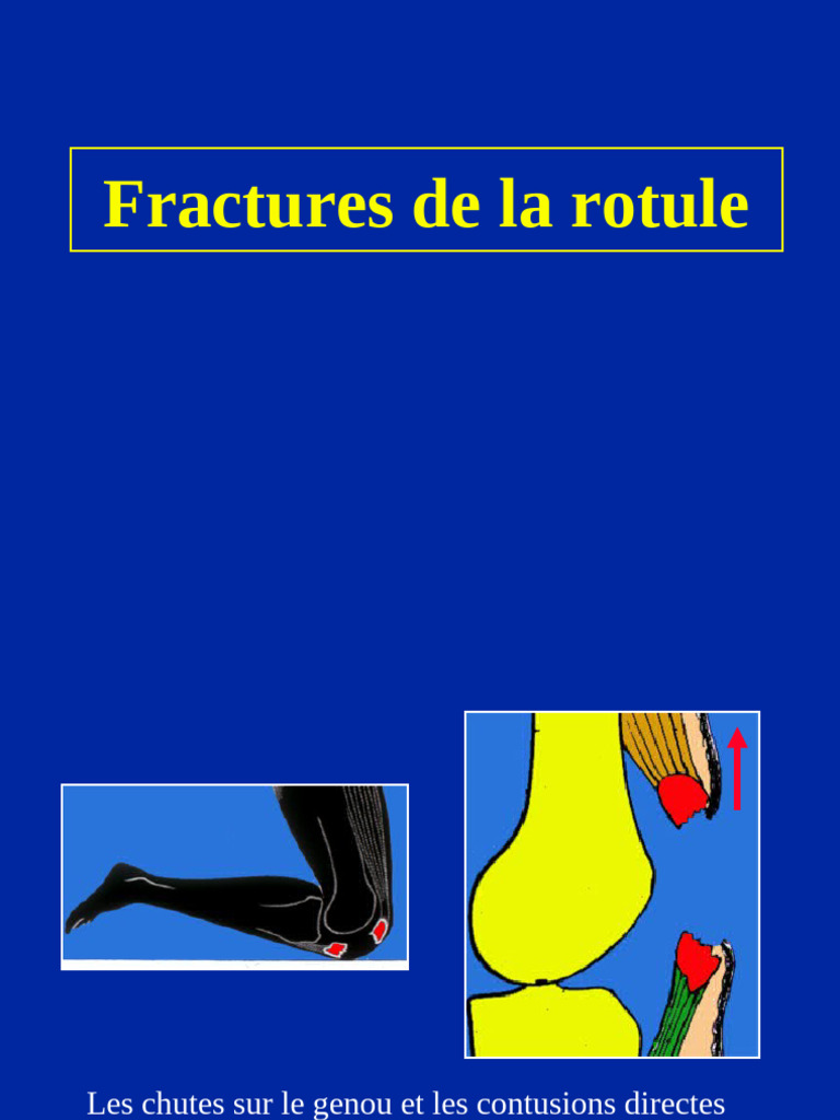 04 - Cours-Fractures de La Rotule | PDF | Genou | Appareil locomoteur