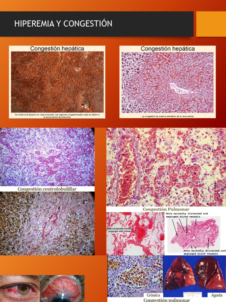 Hiperemia | PDF