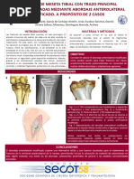 Clasificación de Schatzker en fracturas tibiales | PDF