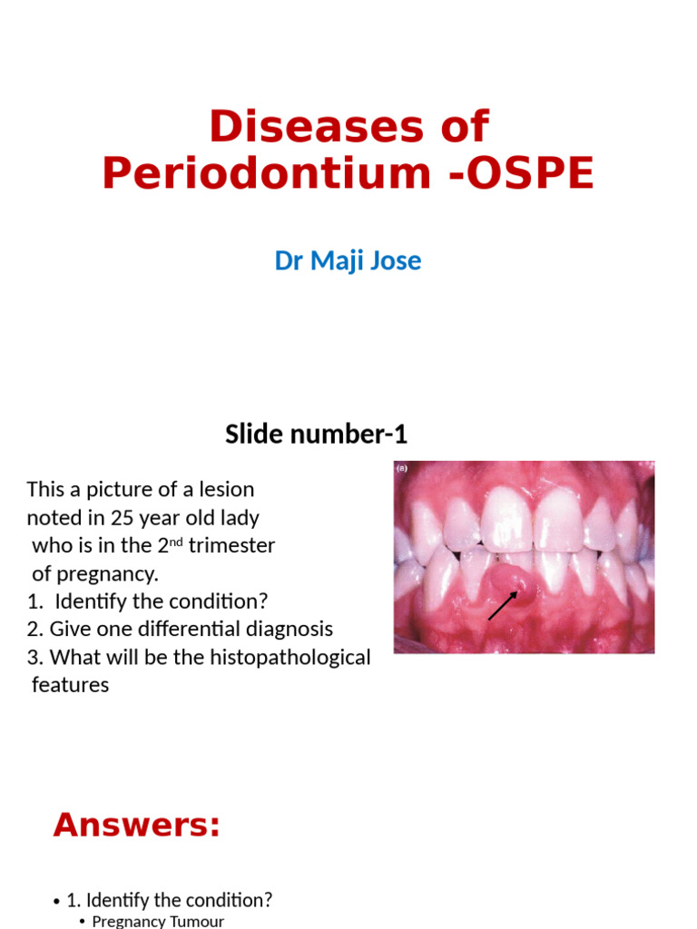 Periodontal Diseases OSPE - DR Maji Jose | PDF | Inflammation ...