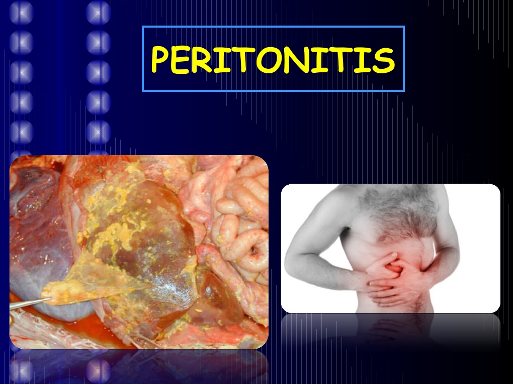 Peritonitis!!!! | PDF | Sistema inmune | Inflamación