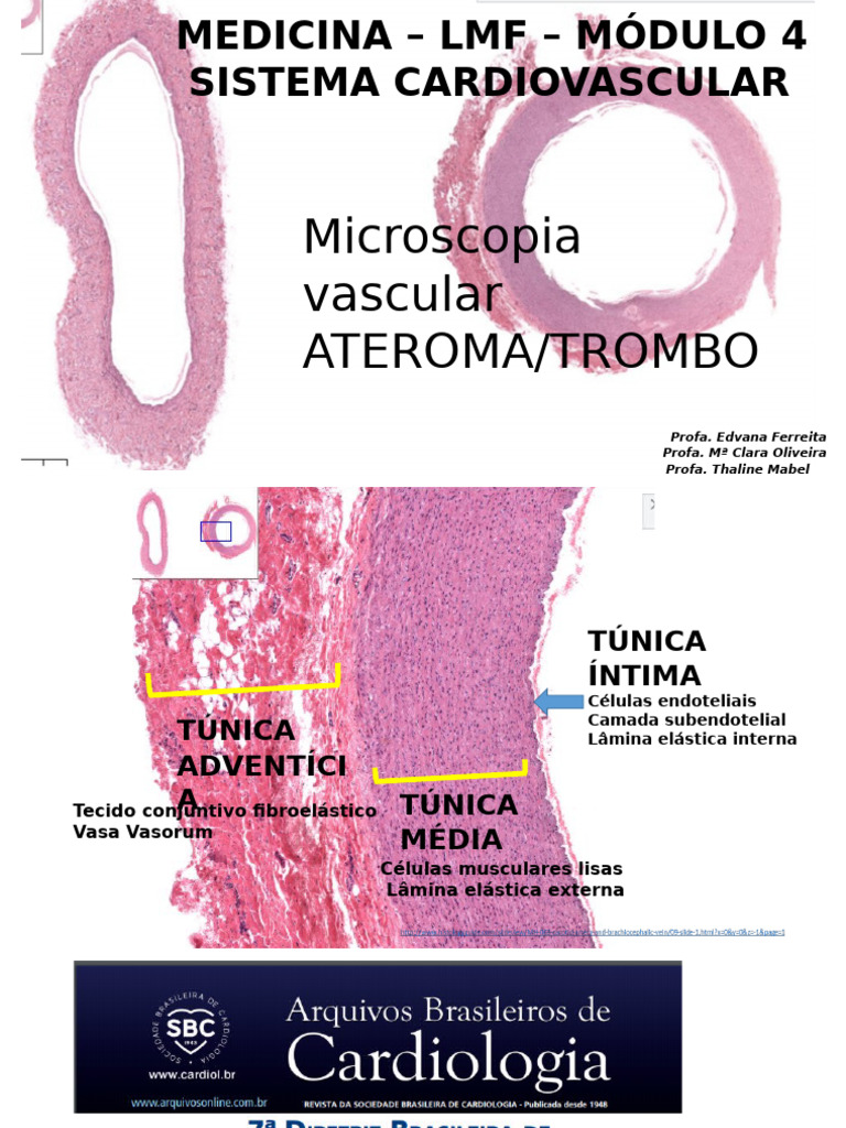 Ateroma Trombo 2023.1 | PDF | Aterosclerose | Artéria