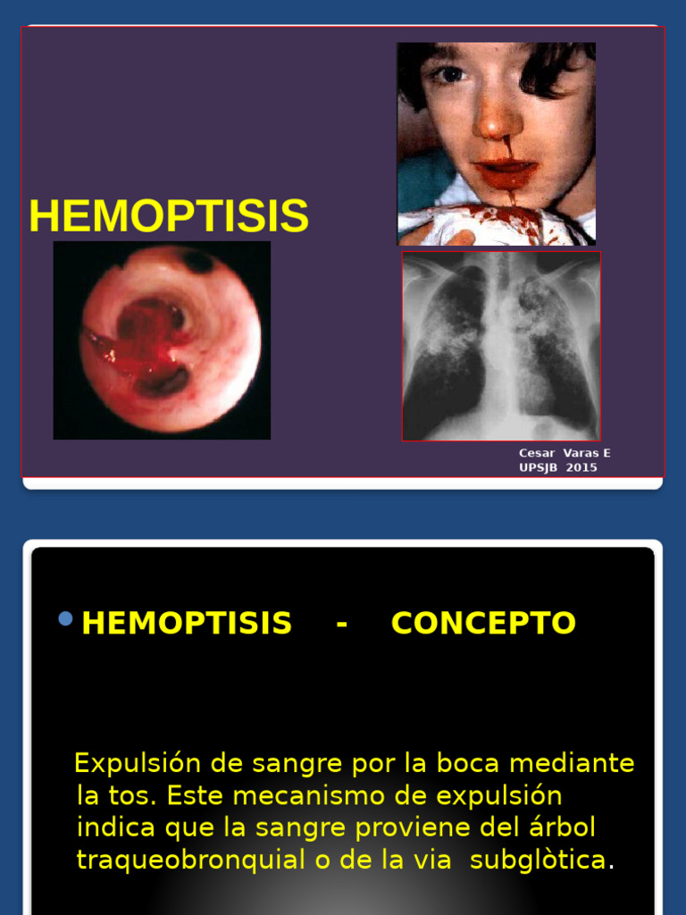 Hemoptisis SJB | PDF | Medicina | Especialidades Medicas