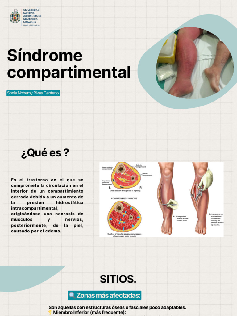 síndrome compartimental | PDF | Especialidades Medicas | Enfermedades y ...
