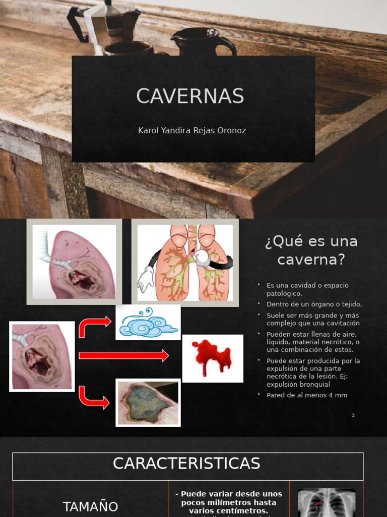 Cavernas 2 | PDF | Tuberculosis | Tos