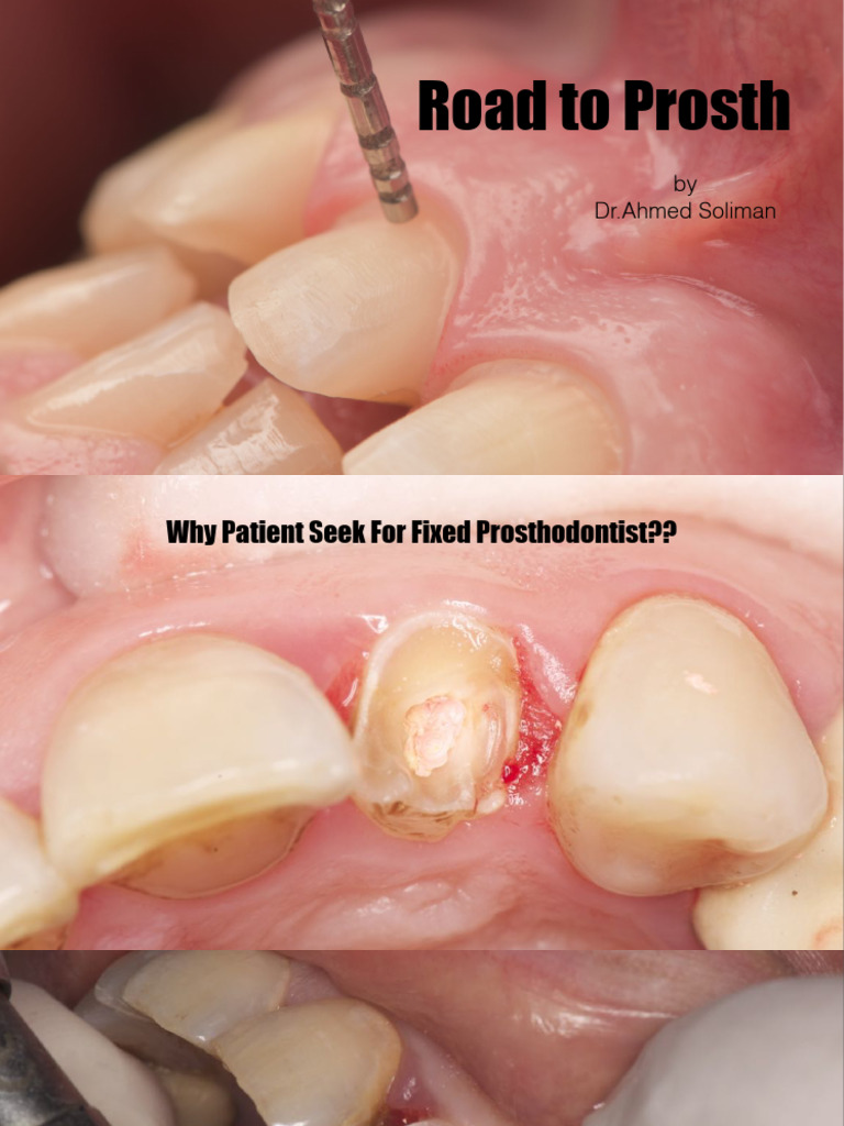 Introduction To Fixed Prosthodontics-1 - 240930 - 135017 | PDF