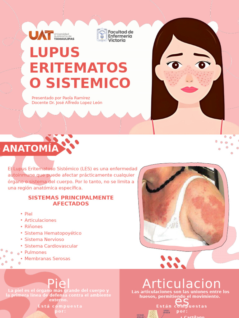 Lupus | PDF | Sistema inmune | Autoinmunidad