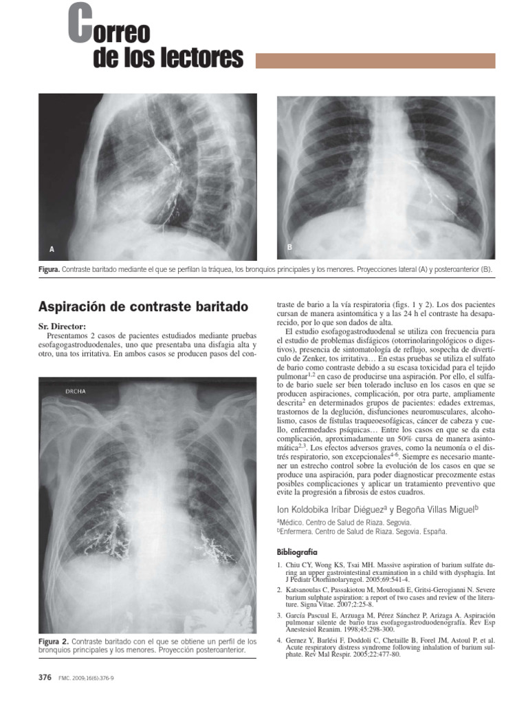 Aspiracion de Contraste Baritado | PDF | Tórax | Tos