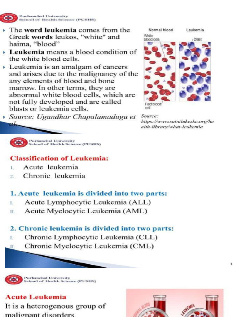 Acute Leukemias | PDF