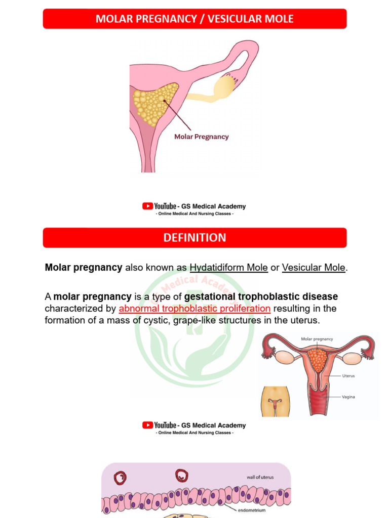 Molar Pregnancy | PDF | Maternal Health | Mammalian Pregnancy
