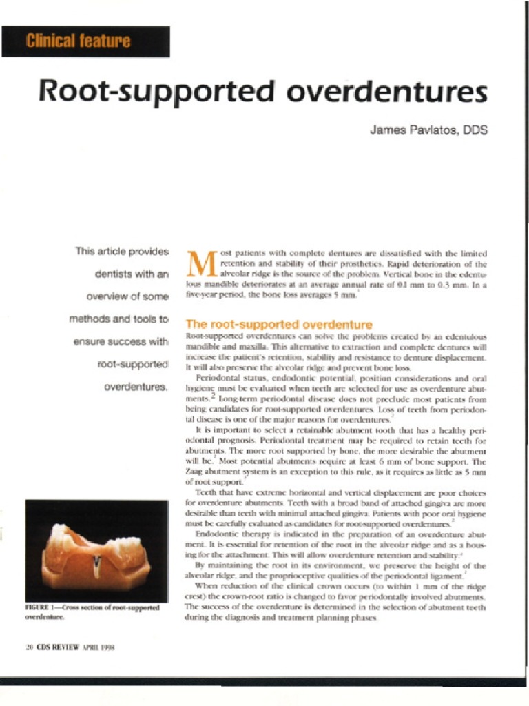 Root Supported Over Dentures | PDF